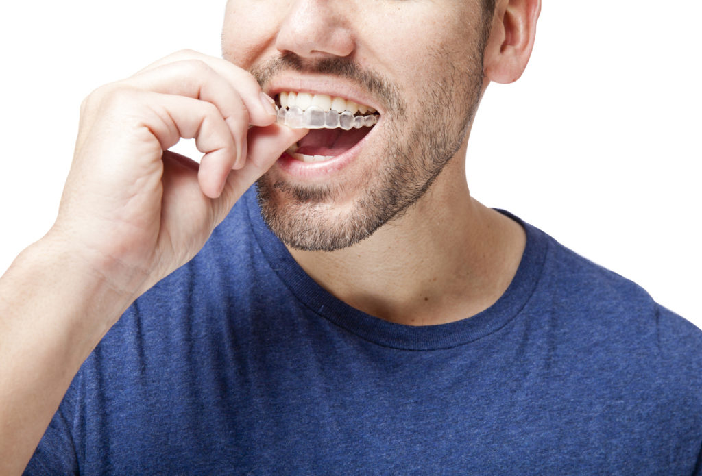 Clear Braces Man - Ponte Vedra Complete Dentistry